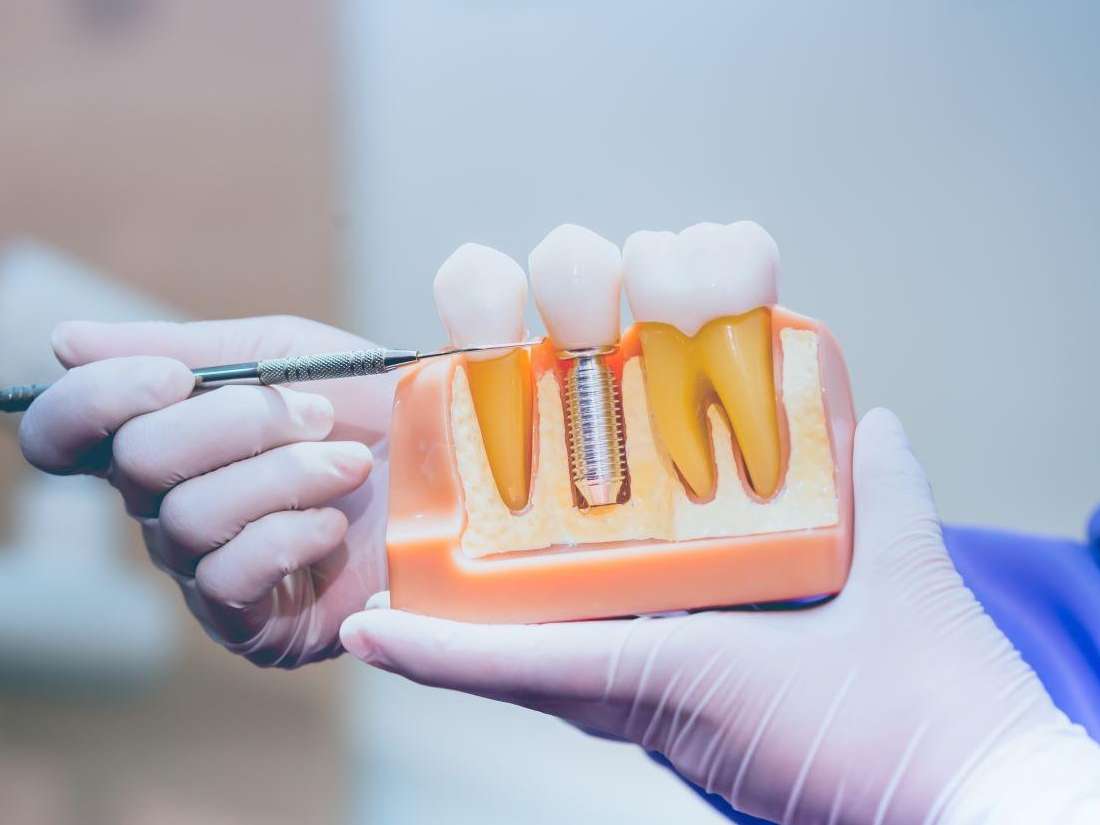 The Long-Term Benefits of Dental Implants for Jonesboro, AR Residents ...